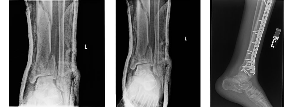 Treatment | Ankle Fractures | Plantar Callus | Greenbrae, CA | Novato, CA