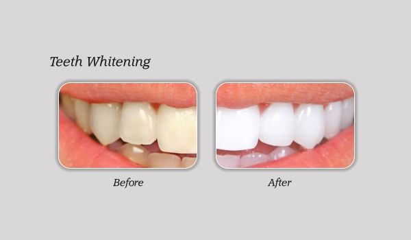 Photo Gallery | Smile Maker Implant & General Dentistry