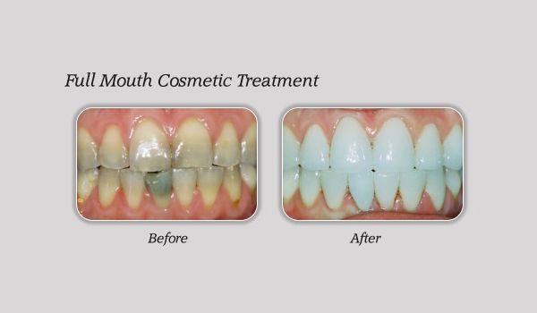 Photo Gallery | Smile Maker Implant & General Dentistry