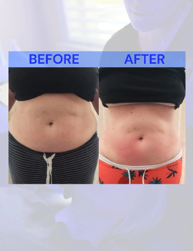 Body Contouring Davenport, FL | Ultra Cryo & Recovery