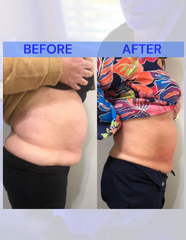 Body Contouring Davenport, FL | Ultra Cryo & Recovery