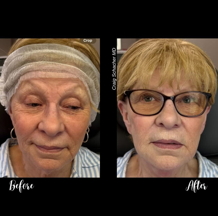 Attiva RF | Bella MedSpa