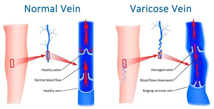 Vascular Conditions | Sun Vein & Vascular | Dallas, TX