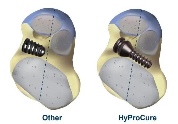 Flat Foot HyProCure Correction | Lakeland, FL