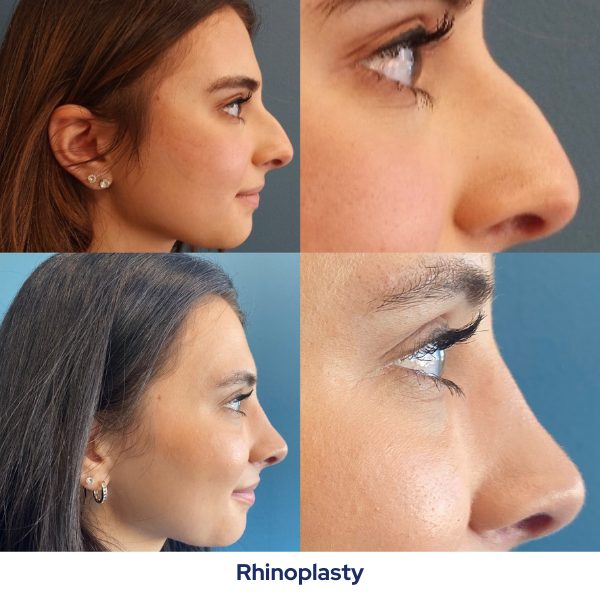 Island Plastic Surgery & Aesthetic Center Before and After Photo Gallery