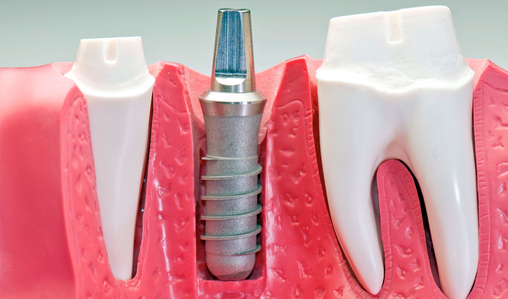 Dental Lab in Austin, TX | ImplantTx Dental Lab