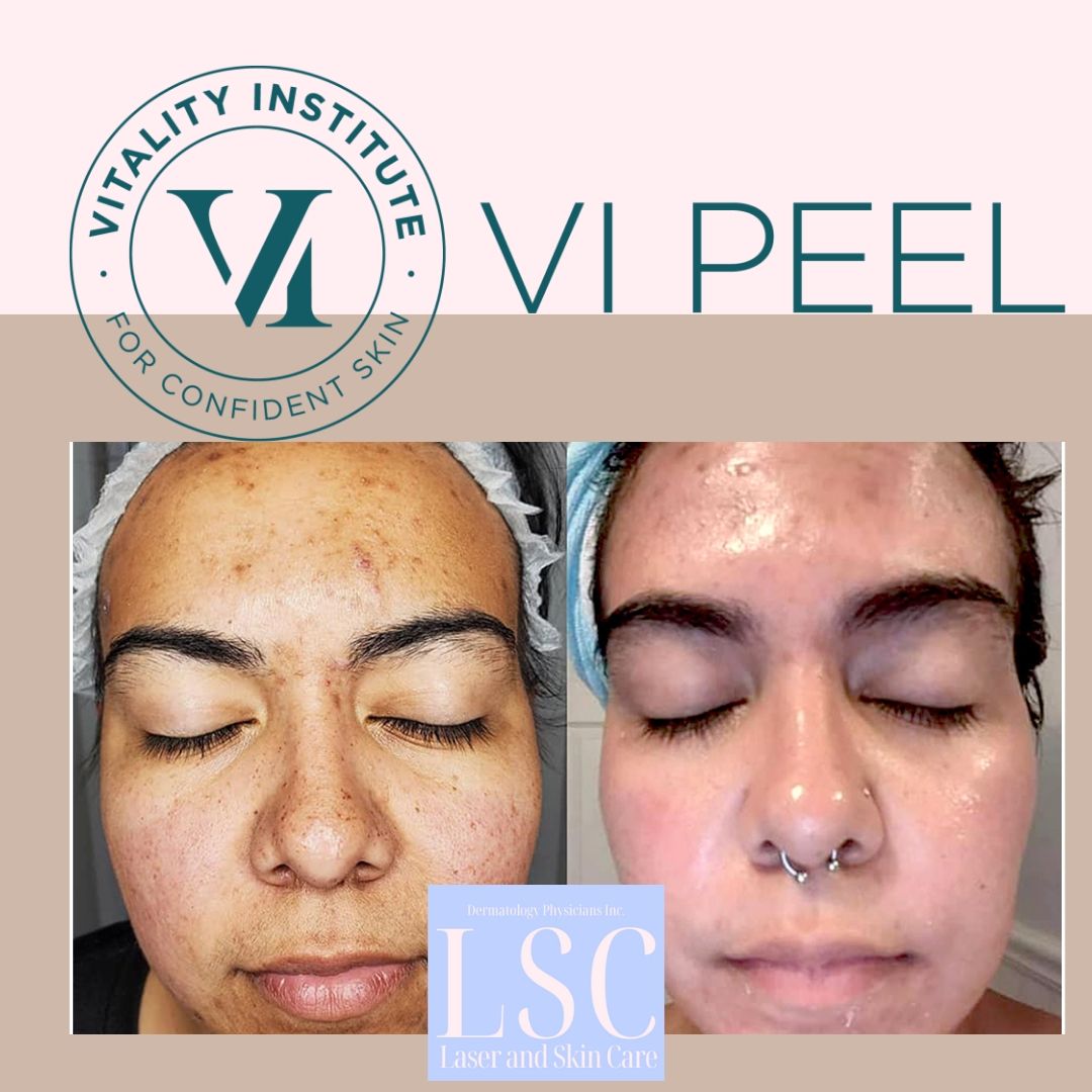 Hair Removal Lancaster, PA | Dermatology Physicians, Inc