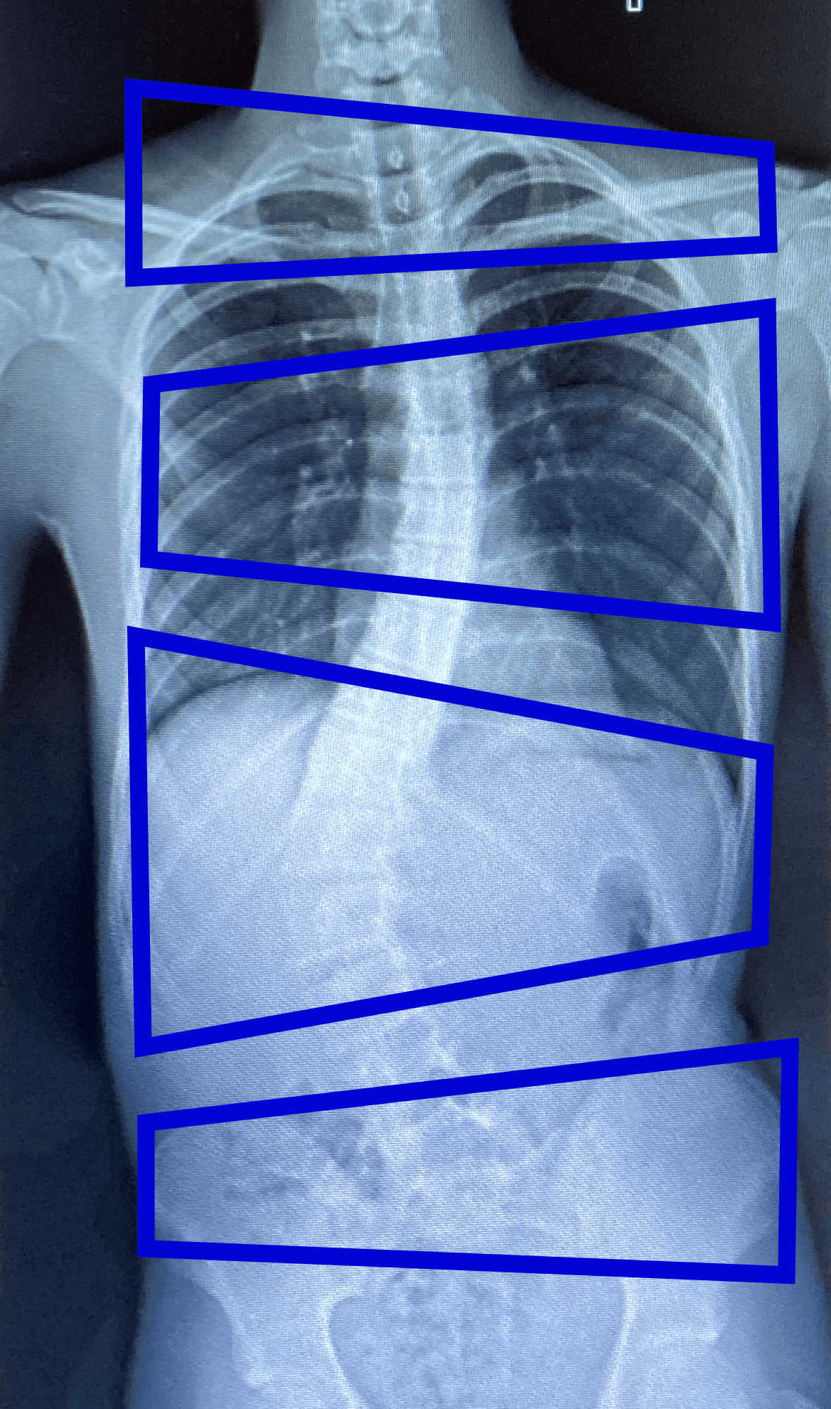 Schroth Scoliosis Therapy | Patterson Physical Therapy | Jackson, TN