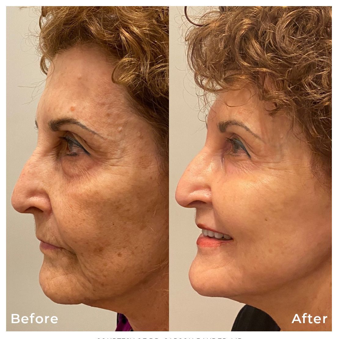 Phoenix CO2 Laser Treatment | Lake In The Hills, IL