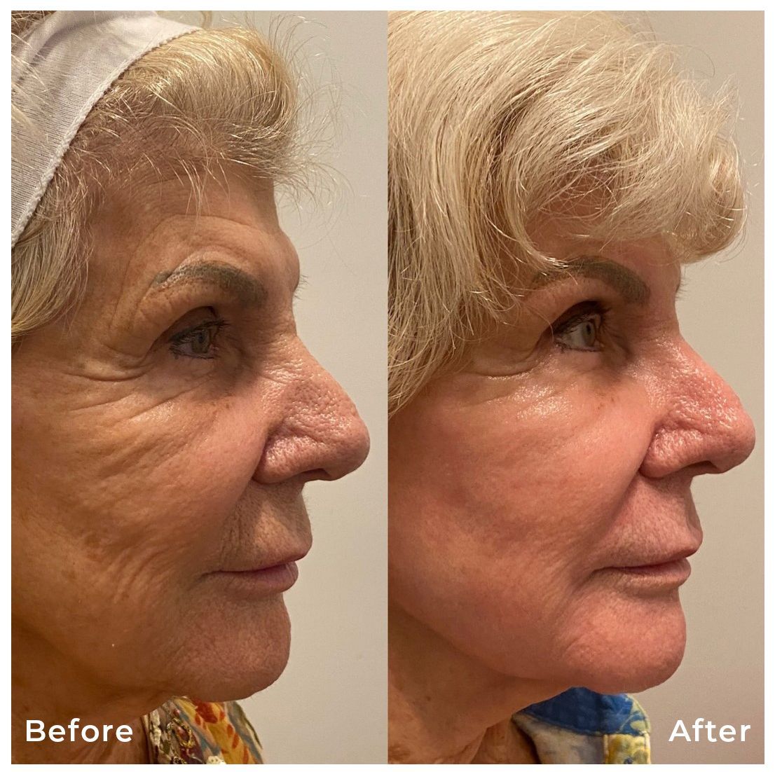 Phoenix CO2 Laser Treatment | Lake In The Hills, IL