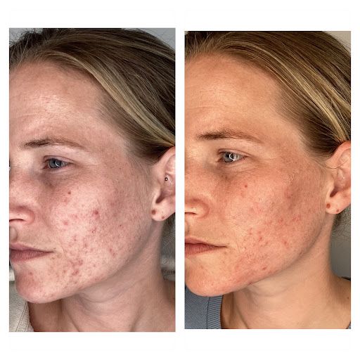 Cryofacial | Cosmetic Treatments | Lake In The Hills, IL