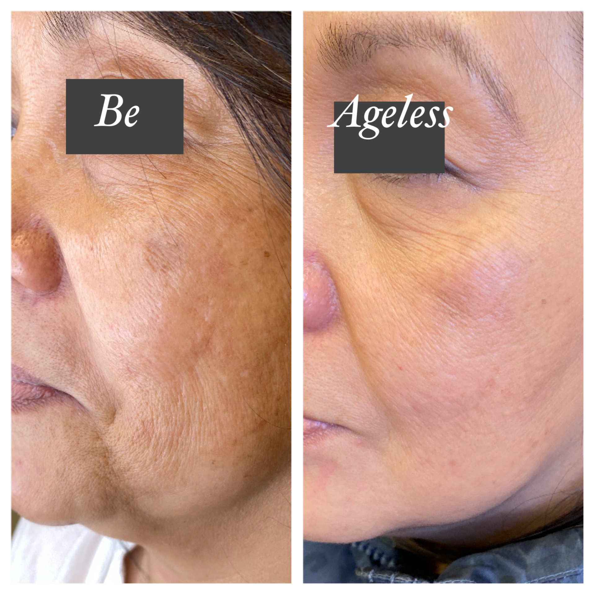 Skin Rejuvenation | Aerolase Laser | Hagerstown, MD
