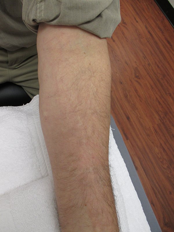 Houston Tattoo Removal Clinic Photo Gallery Houston, TX