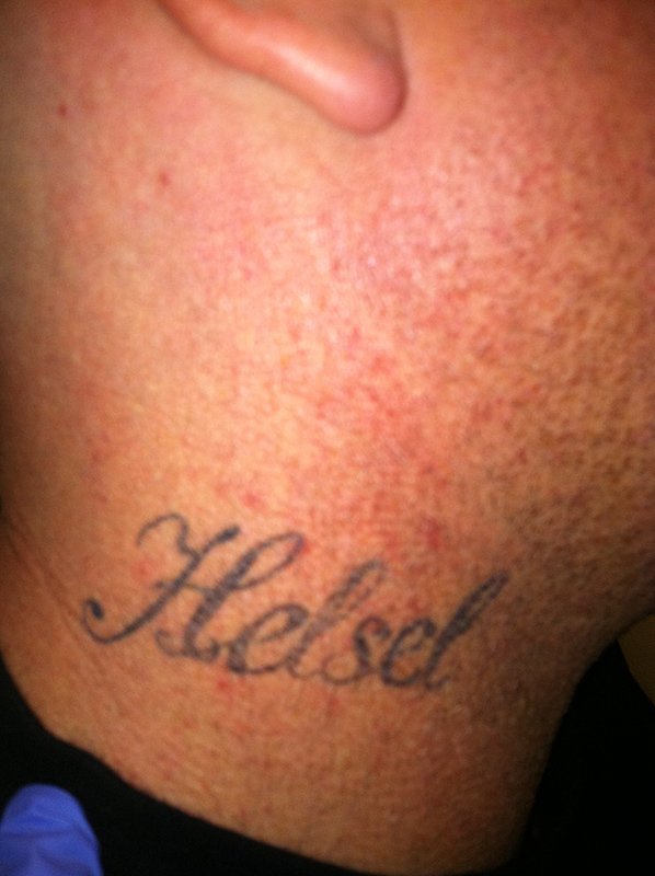 Houston Tattoo Removal Clinic Photo Gallery Houston, TX