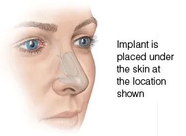 Nasal Obstruction Care | Nasal Implants | Villa Rica, GA
