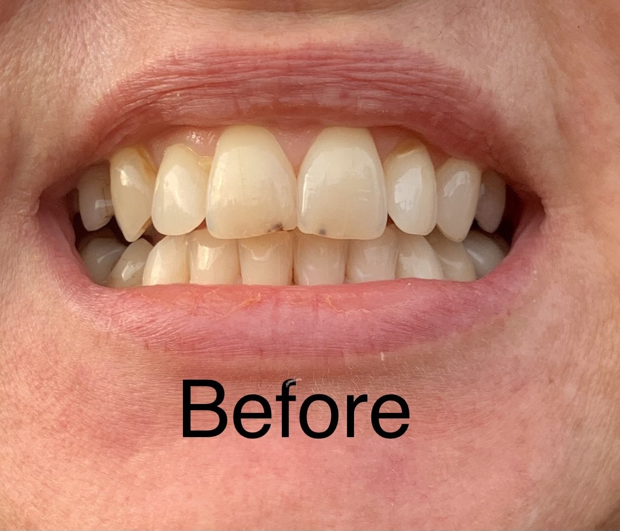 Cosmetic Dentistry and Teeth Whitening | Papillion, NE