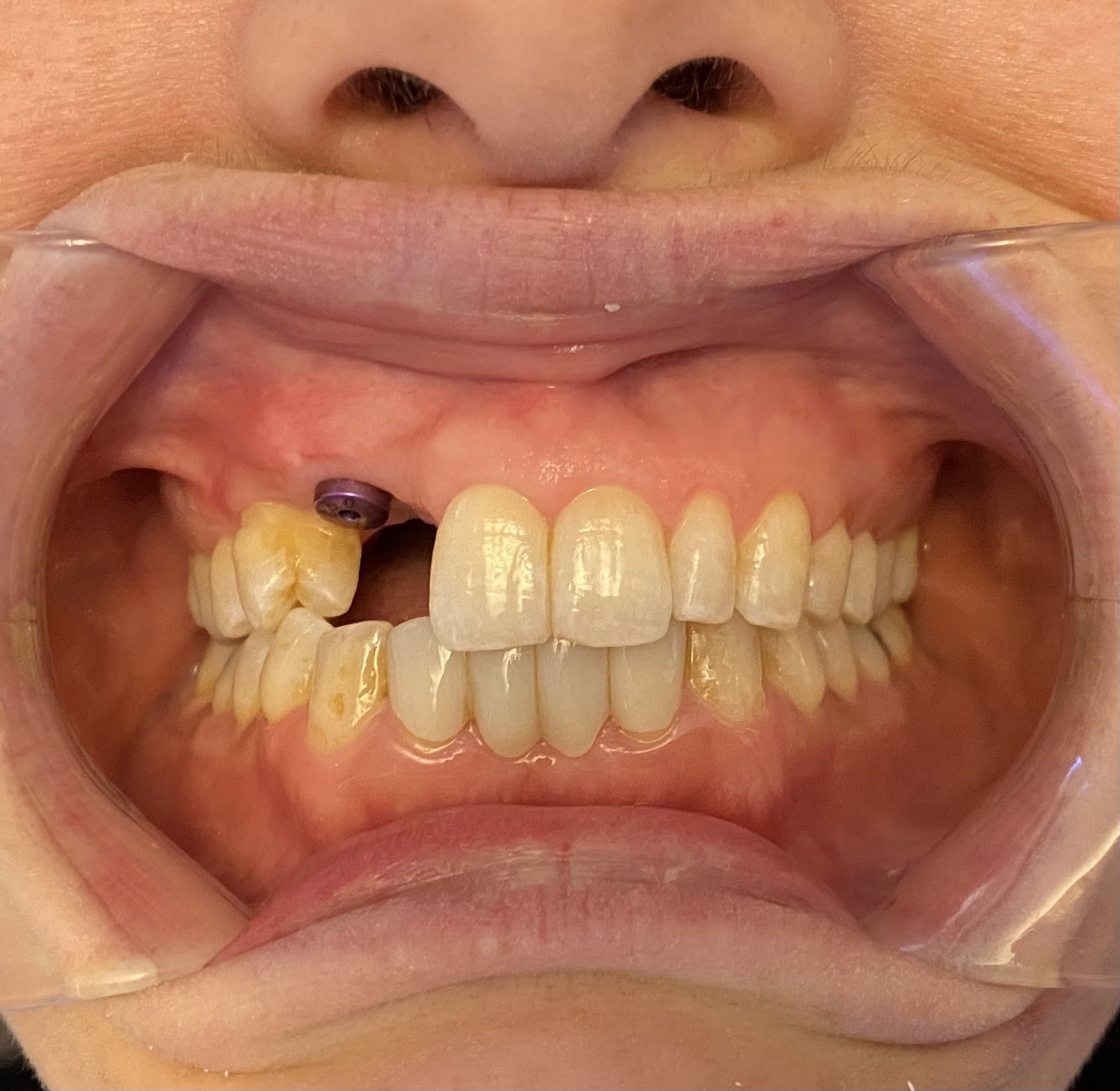 Shadow Lake Family and Cosmetic Dentistry-Chris Foix, D.D.S. P.C. Papillion