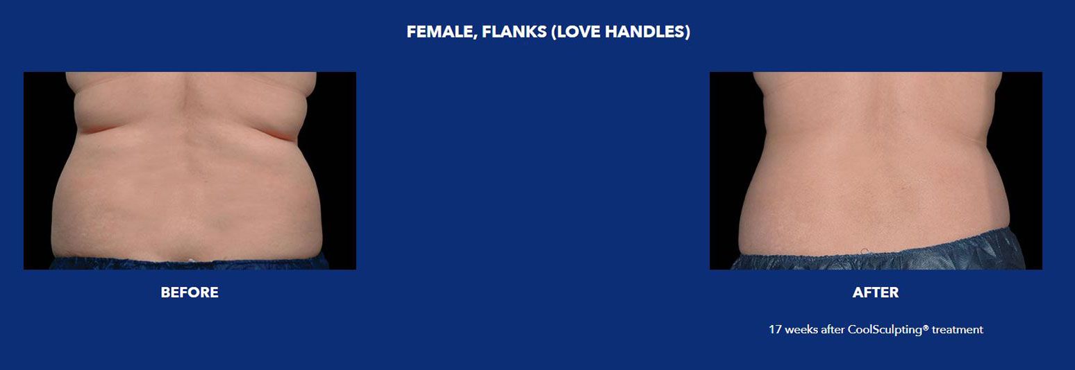 CoolSculpting Palm Desert, CA | Indian Wells, CA