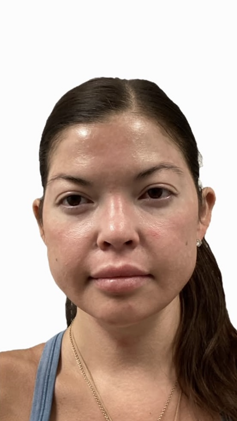 Before & After Gallery | Wilson MD Aesthetics + Wellness | Scottsdale, AZ
