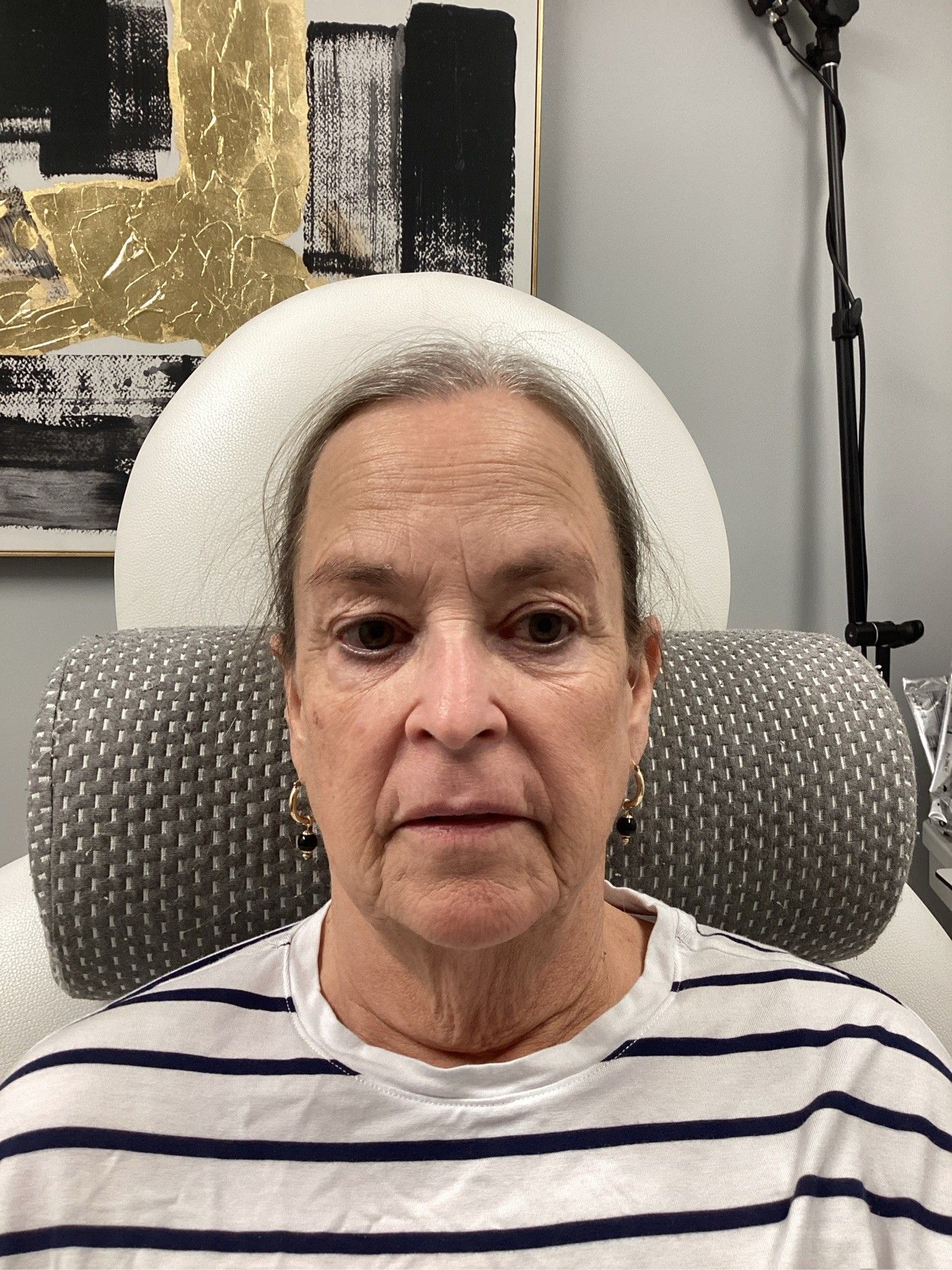 Before & After Gallery | Wilson MD Aesthetics + Wellness | Scottsdale, AZ