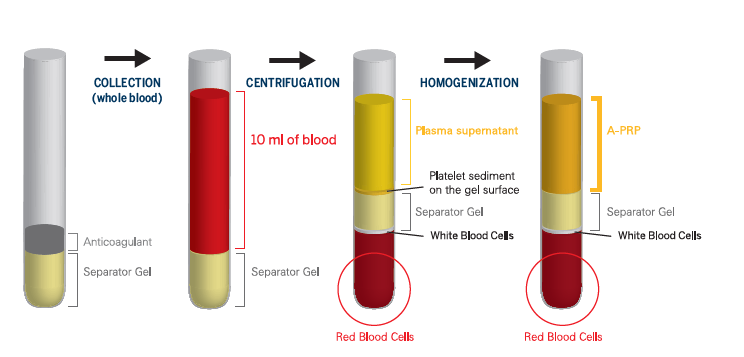 Platelet-Rich Plasma Injections Services | Murrieta, CA