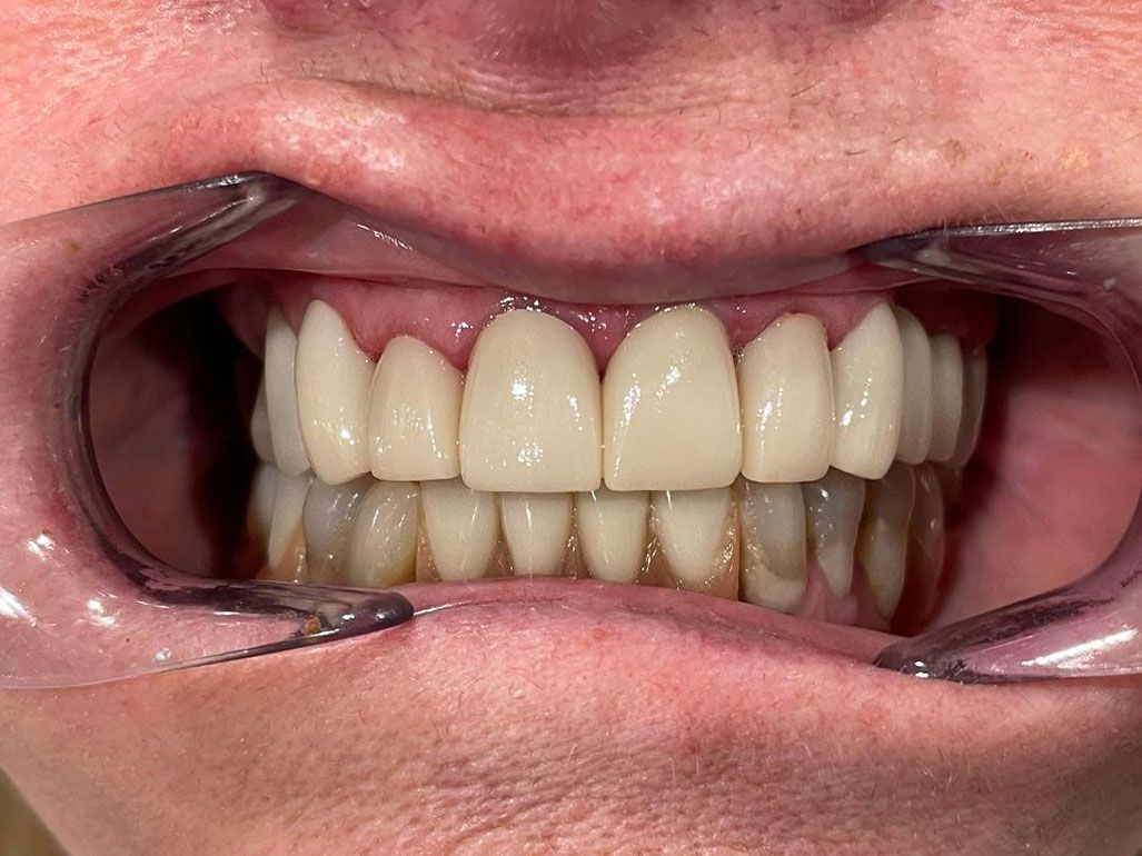 Smile Gallery | Broadway Dental Associates PA