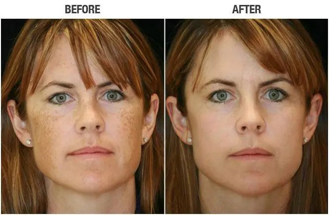 ATTIVA Skin Tightening in Aurora, CO | Centennial Eye & Cosmetic Associates