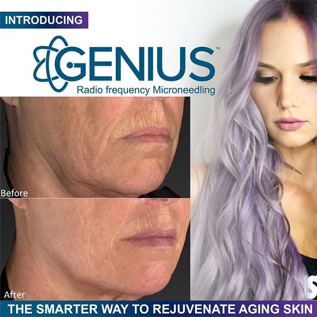 Genius RF | Non-Surgical Facial Resurfacing | Westfield, MA