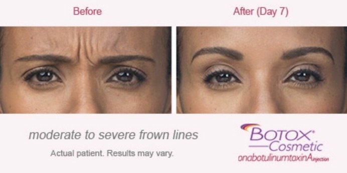 Botox Treatment | Homewood, AL