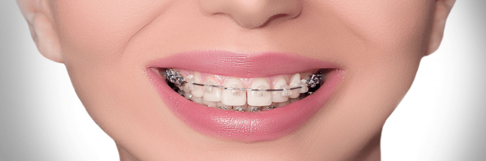 Braces | In-Ovation Braces | Greeneville, TN
