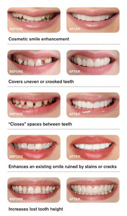 Snap-On Smile | Removable Dental Arches | Wilkes-Barre, PA