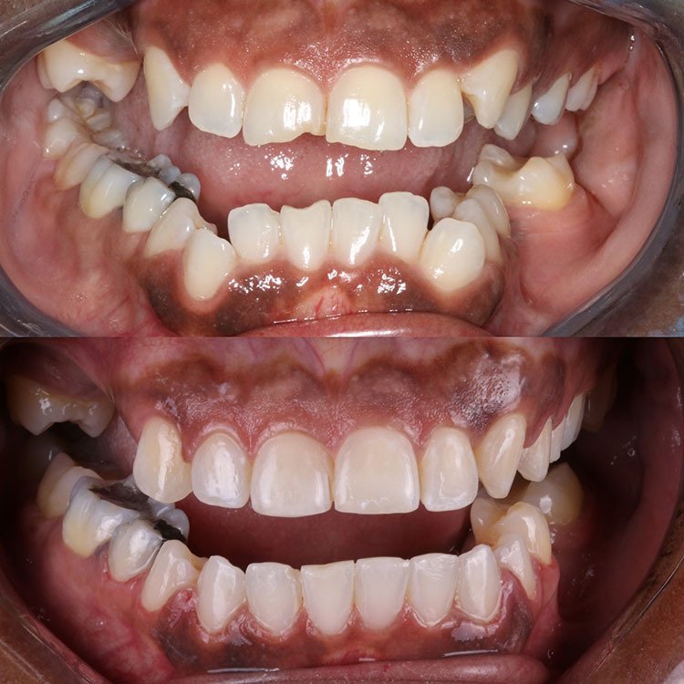 Invisalign | Smile Improvement | Brandon, MS