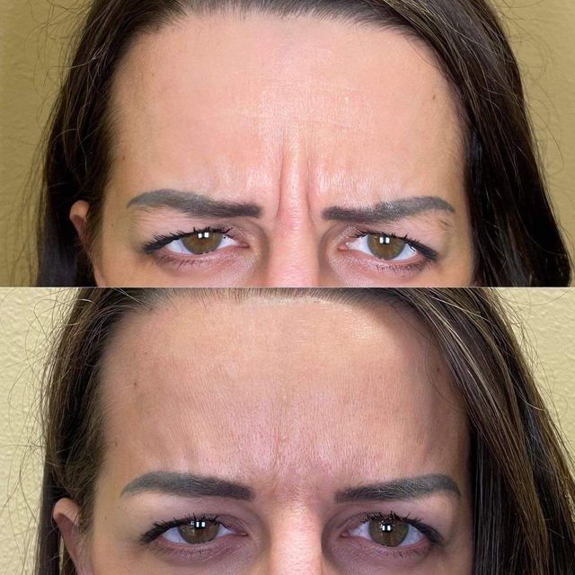 Botox and Dermal Filler Services | Marinette, WI