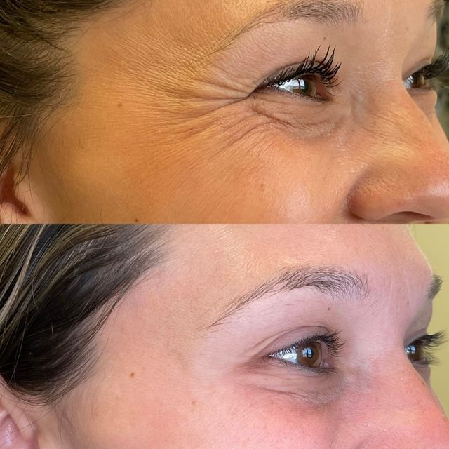 Botox and Dermal Filler Services | Marinette, WI